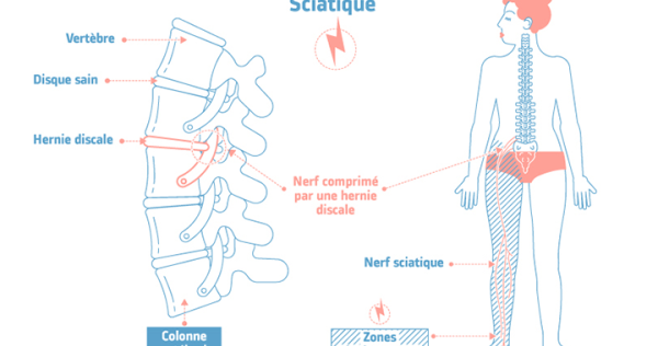Sciatique : comment traiter la douleur ? | MMJ